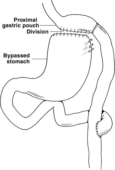Historical Perspectives of Bariatric Surgery | SpringerLink
