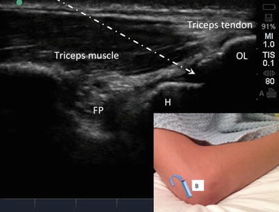 Elbow Joint and Tennis Elbow Injection | SpringerLink