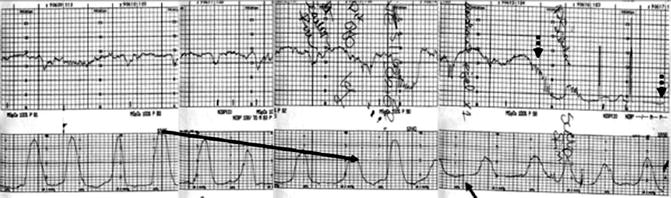 Spontaneous Uterine Rupture | SpringerLink