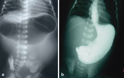 Congenital Gastric Outlet Obstruction (Pyloric and Antral Atresia and ...