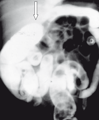 Hirschprung’s Disease (Congenital Aganglionic Megacolon) | SpringerLink