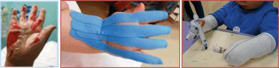 Splinting, Positioning, Edema, and Scar Management After Burn Injury ...