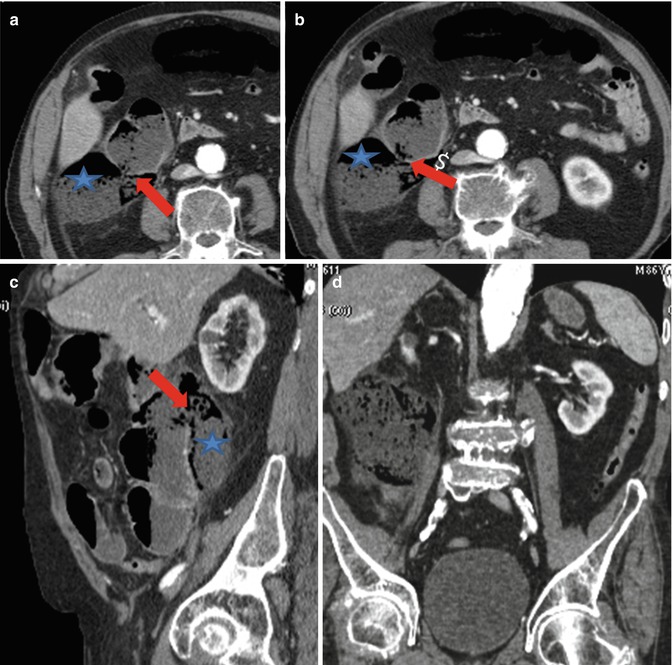 Role of Multidetector Row Computed Tomography in the Diagnosis of Acute ...