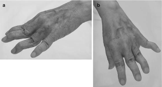 Symptoms and Signs of Parkinson’s Disease and Other Movement Disorders ...