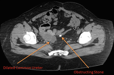 Percutaneous Nephrolithotomy and Antegrade Ureteroscopy | SpringerLink