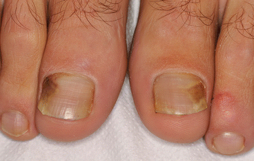 Differential Diagnosis for Nail Psoriasis | SpringerLink