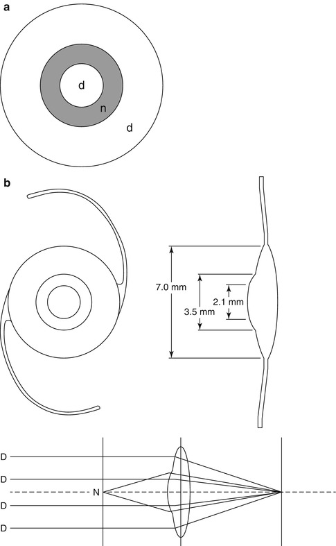 Multifocal Intraocular Lenses: Historical Perspective | SpringerLink
