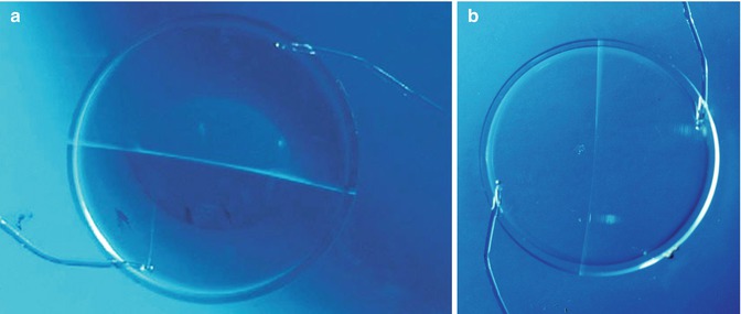 Multifocal Intraocular Lenses: Historical Perspective | SpringerLink