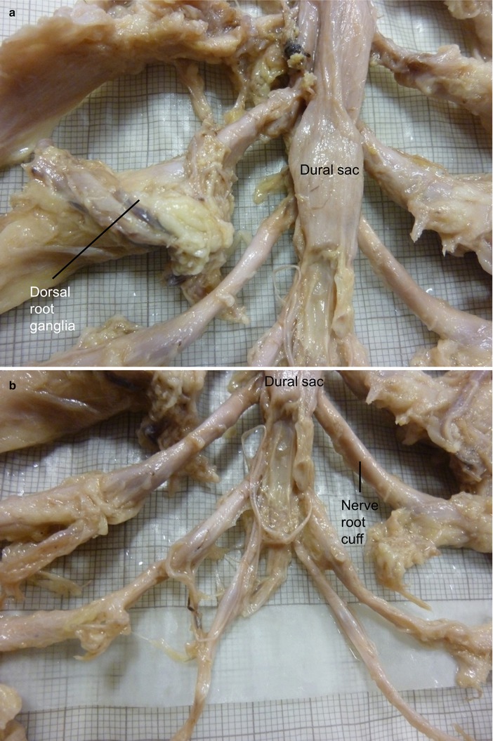 Spinal Dural Sac, Nerve Root Cuffs, Rootlets, and Nerve Roots ...