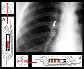 Complications Related to the Type of Hydrocephalus: Normal Pressure ...