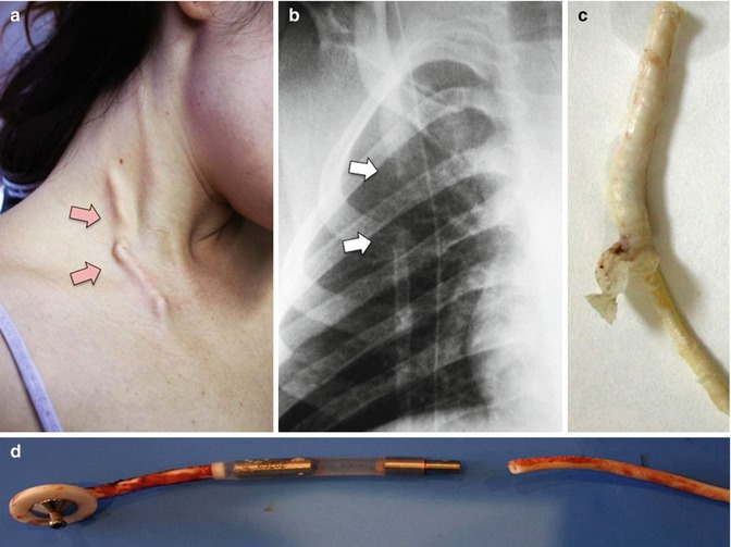 Clinical Manifestations of CSF Shunt Complications | SpringerLink
