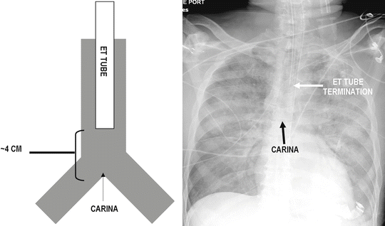 Tubes and Lines | SpringerLink