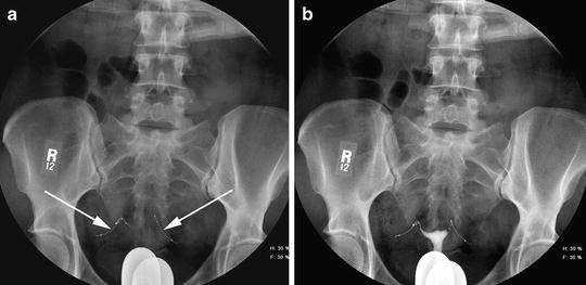 Abdominal Hardware and Tubes | SpringerLink