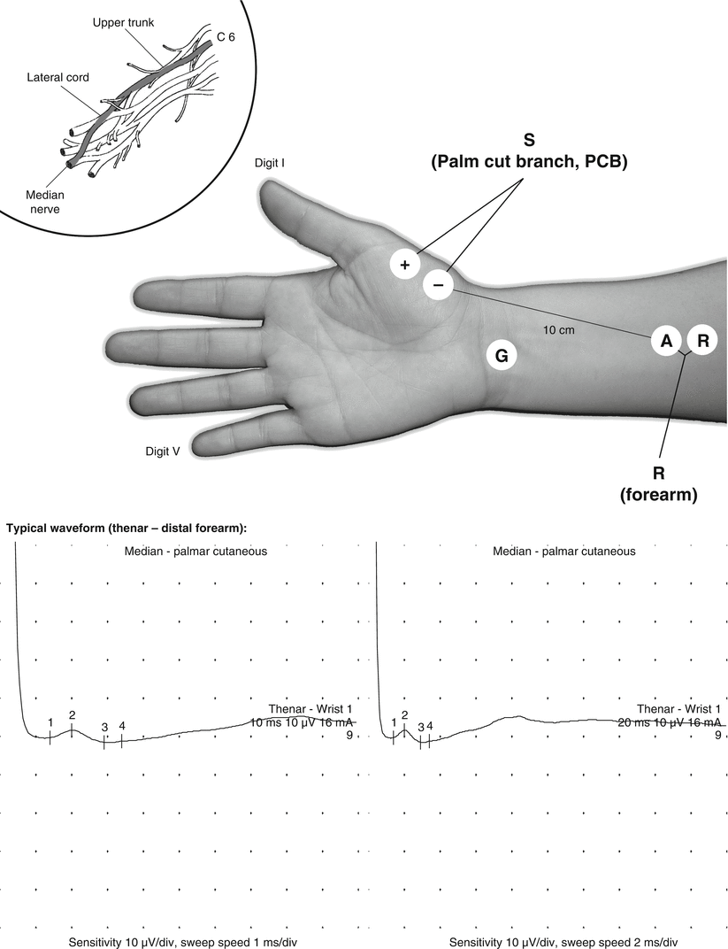 Thenar – Forearm | SpringerLink