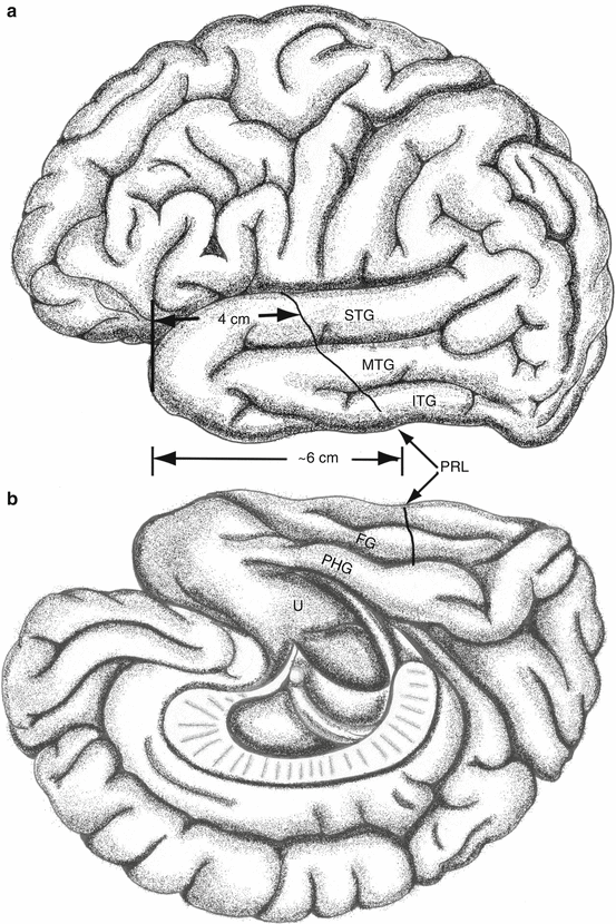 Temporal Lobe Surgery | SpringerLink