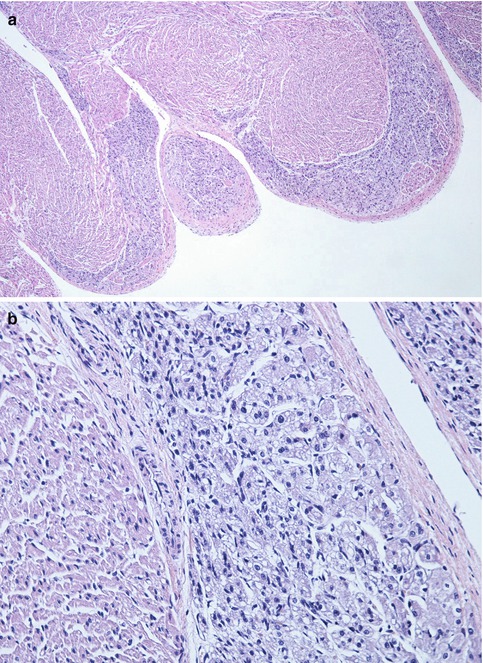 Pathology of the Cardiac Conduction System | SpringerLink