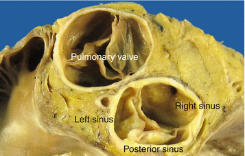 Pathology of the Heart Valves | SpringerLink