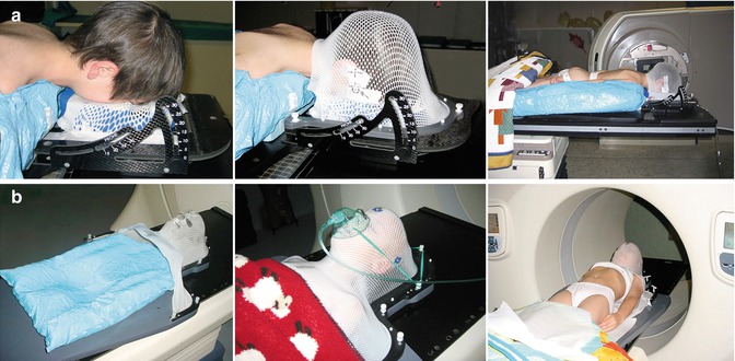 Radiotherapy in Medulloblastoma | SpringerLink