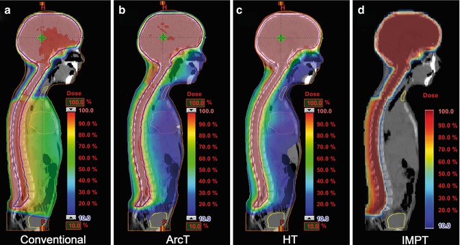 Radiotherapy in Medulloblastoma | SpringerLink