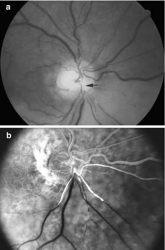 Hemicentral Retinal Artery Occlusion | SpringerLink