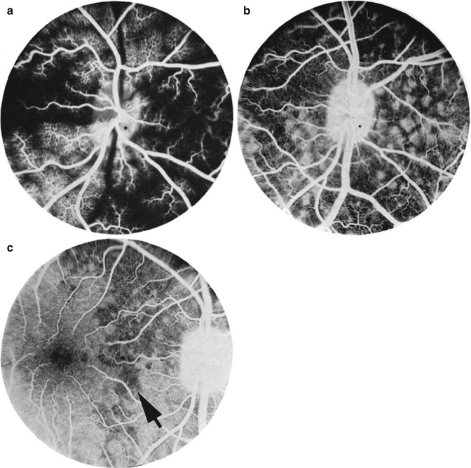 Vortex Vein Occlusion | SpringerLink