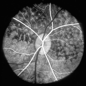 Vortex Vein Occlusion | SpringerLink