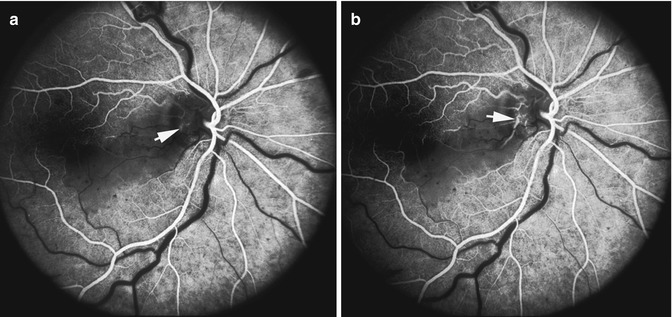 Amaurosis Fugax in Ocular Vascular Occlusive Disorders | SpringerLink