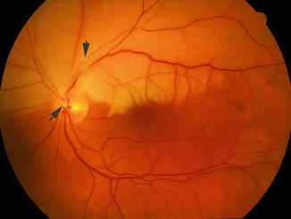 Amaurosis Fugax in Ocular Vascular Occlusive Disorders | SpringerLink