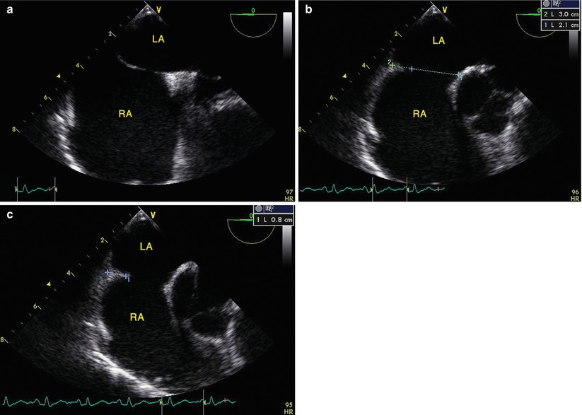 Atrial Septal Defect (ASD) Ostium Secundum Type | SpringerLink