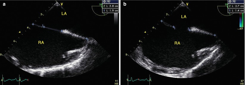 Atrial Septal Defect (ASD) Ostium Secundum Type | SpringerLink