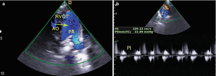 Tricuspid Atresia with Inlet VSD | SpringerLink