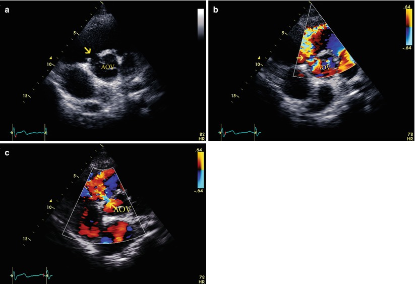 Residual Ventricular Septal Defect Post Surgery (Patch Closure ...