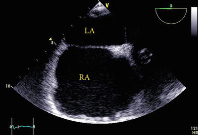 Atrial Septal Defect (Ostium Secundum Type) Closure by the Amplatzer ...