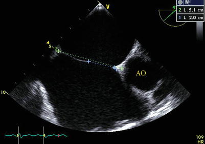Atrial Septal Defect (Ostium Secundum Type) Closure by the Amplatzer ...