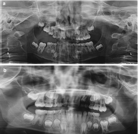 Failure of Tooth Eruption: Diagnosis and Management | SpringerLink