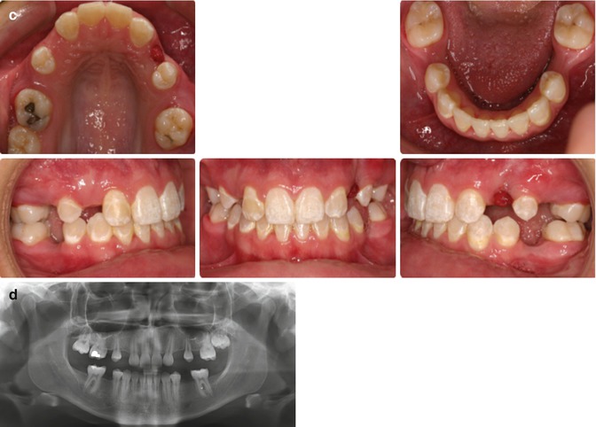 Failure of Tooth Eruption: Diagnosis and Management | SpringerLink