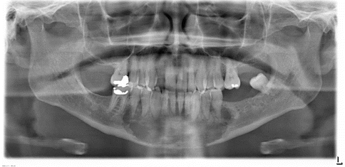 Conditions Associated with Premature Exfoliation of Primary Teeth or ...
