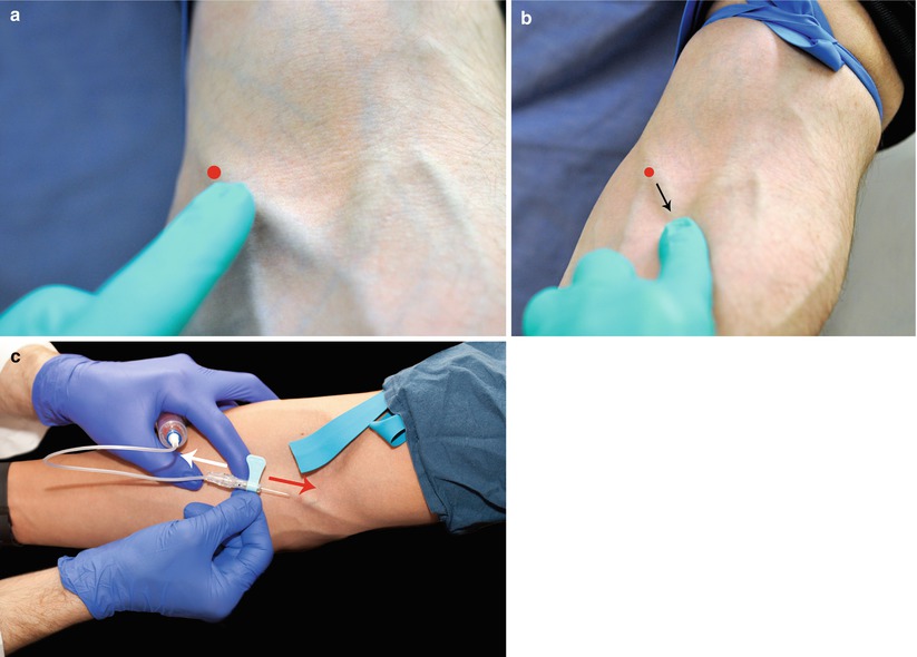 Venipuncture | SpringerLink