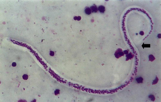 Lymphatic Filariasis | SpringerLink