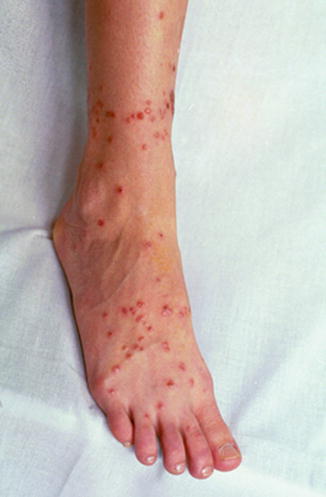 Diseases Caused by Acari (Ticks and Mites) | SpringerLink