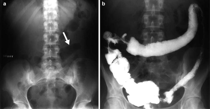Diagnostic Fluoroscopy for Imaging Crohn’s Disease | SpringerLink