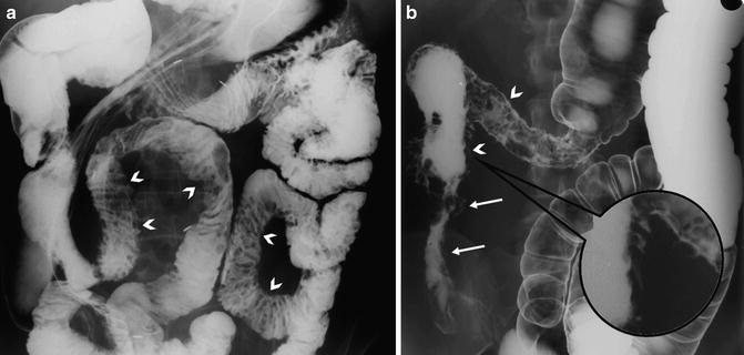 Diagnostic Fluoroscopy for Imaging Crohn’s Disease | SpringerLink