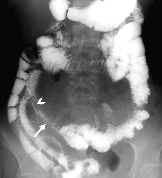 Diagnostic Fluoroscopy for Imaging Crohn’s Disease | SpringerLink