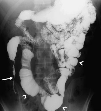 Diagnostic Fluoroscopy for Imaging Crohn’s Disease | SpringerLink