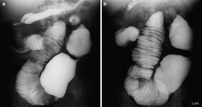Diagnostic Fluoroscopy for Imaging Crohn’s Disease | SpringerLink
