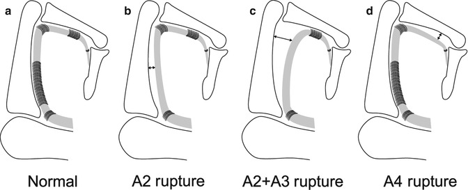 Imaging of Rock Climbing Injuries | SpringerLink