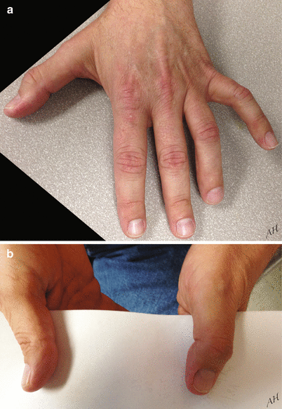 Ulnar Nerve | SpringerLink