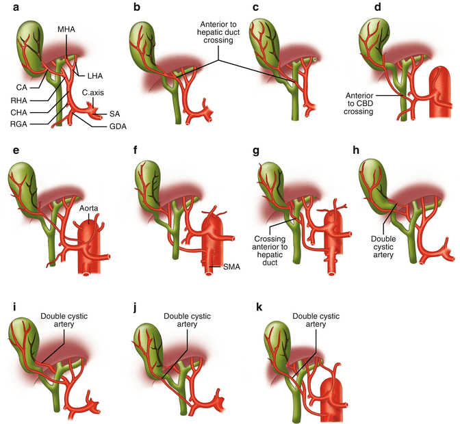 Normal Biliary Anatomy and Pathophysiology of Gallstones | SpringerLink