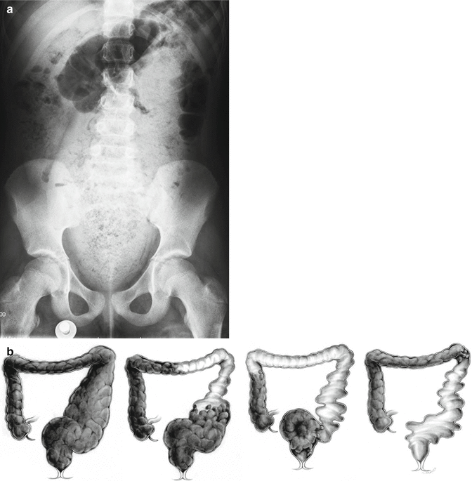 Idiopathic Constipation and Other Motility Disorders | SpringerLink
