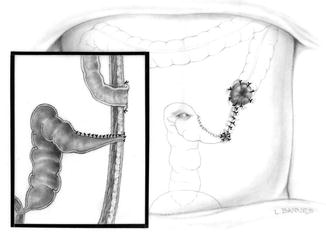 Colostomy | SpringerLink
